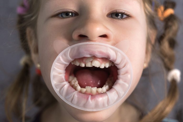 Shark Teeth in Kids: Important Things Parents Should Know